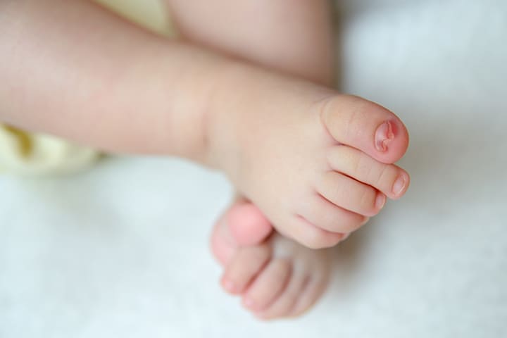Tratamiento de uñeros (Onicocriptosis) en niños – Podomeds