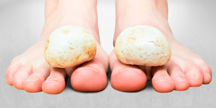 Tratamiento de hongos en la piel (Pie de Atleta y Dermatomicósis ...